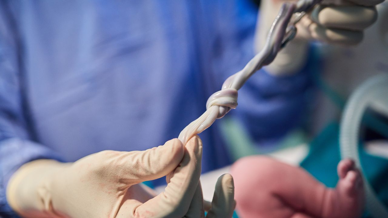 What Happens If An Umbilical Cord Is Around My Baby’s Neck? | Dr Guy ...